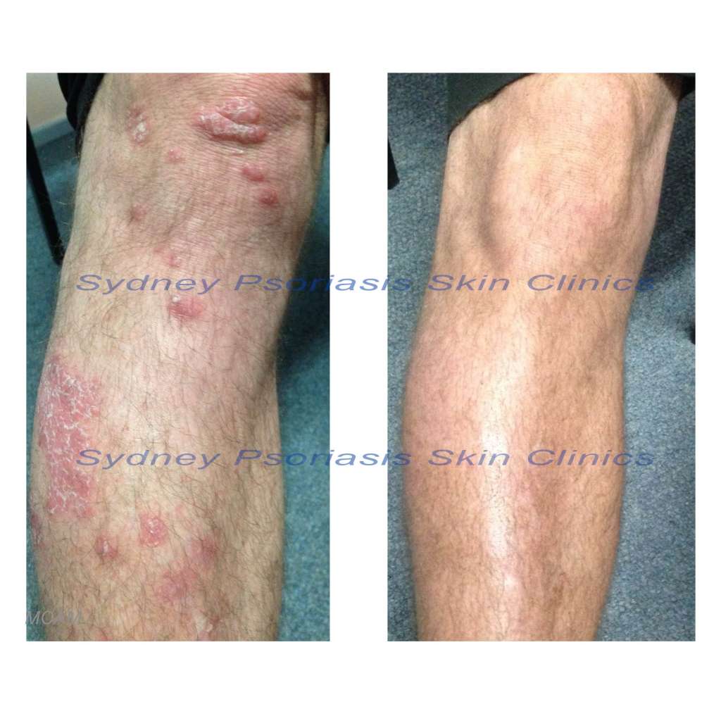 Photos | Sydney Psoriasis Skin Clinics