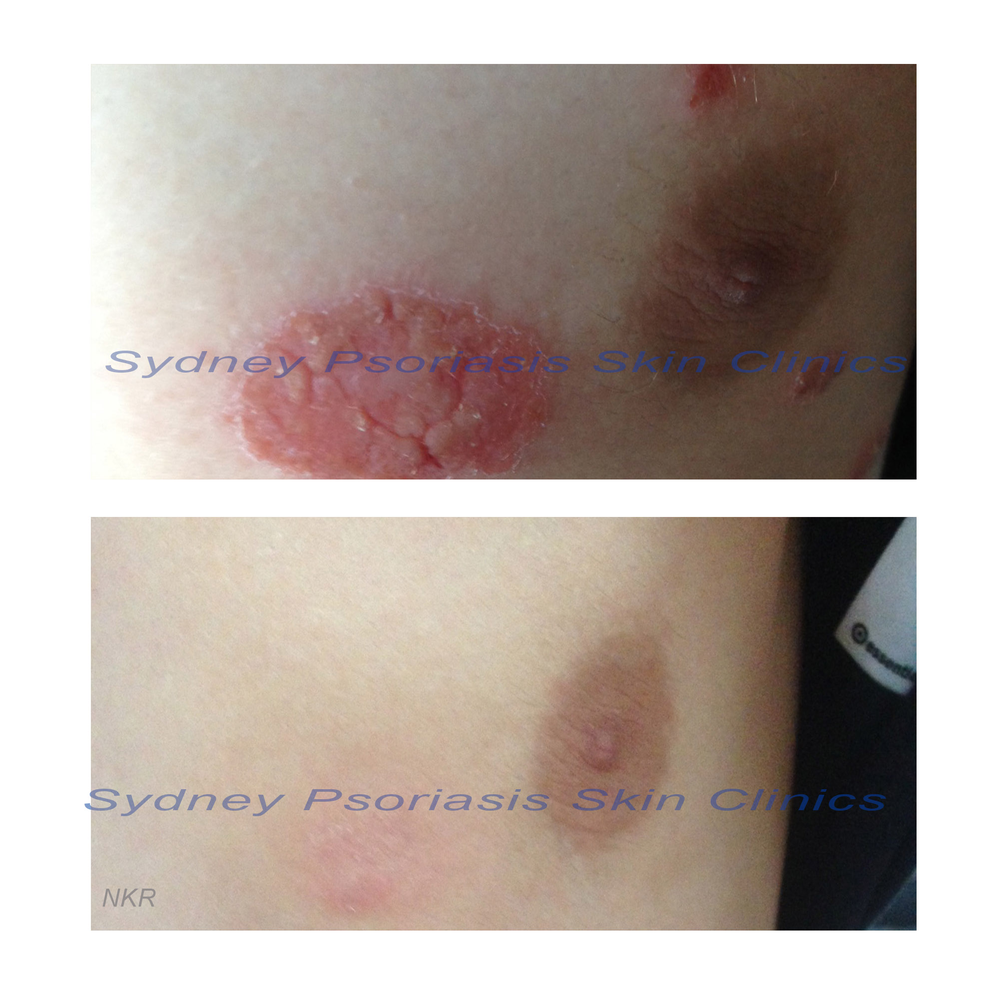 Photos | Sydney Psoriasis Skin Clinics